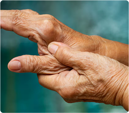 CMC Osteoarthritis Treatment | Get Custom Splints & Therapy